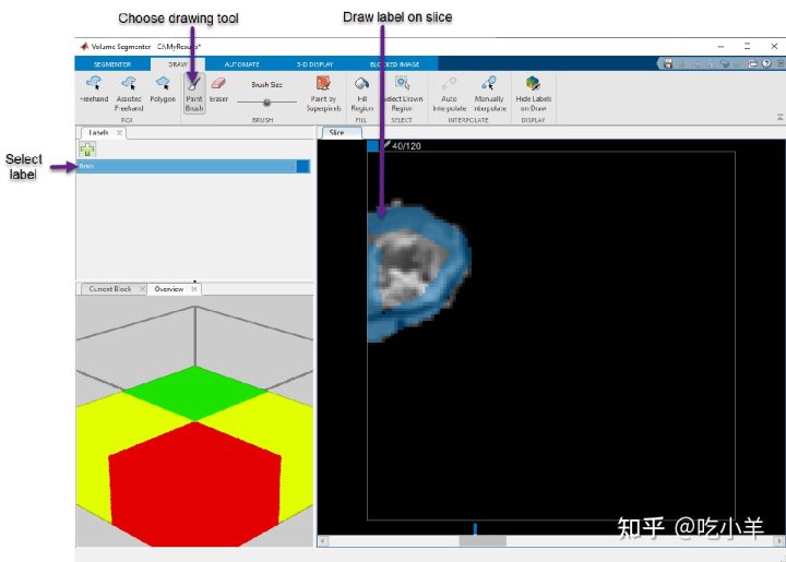MATLAB图像处理：92：使用 Volume Segmenter 处理被阻止的图像